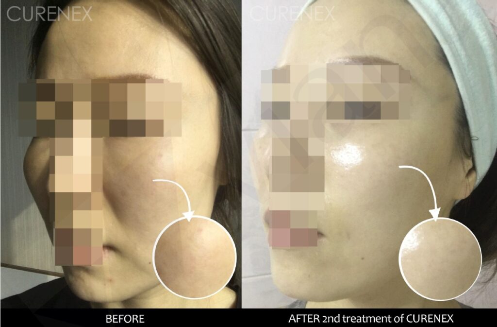 Curenex PDRN Skinbooster (5mL) | meamo