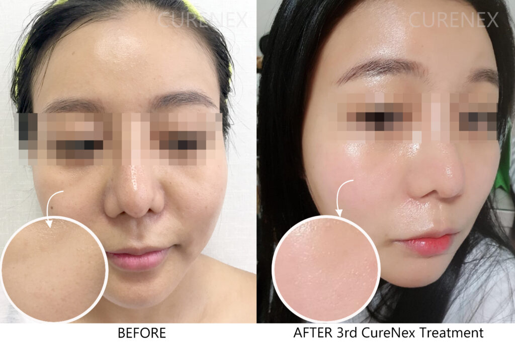 Curenex PDRN Skinbooster (5mL) | meamo